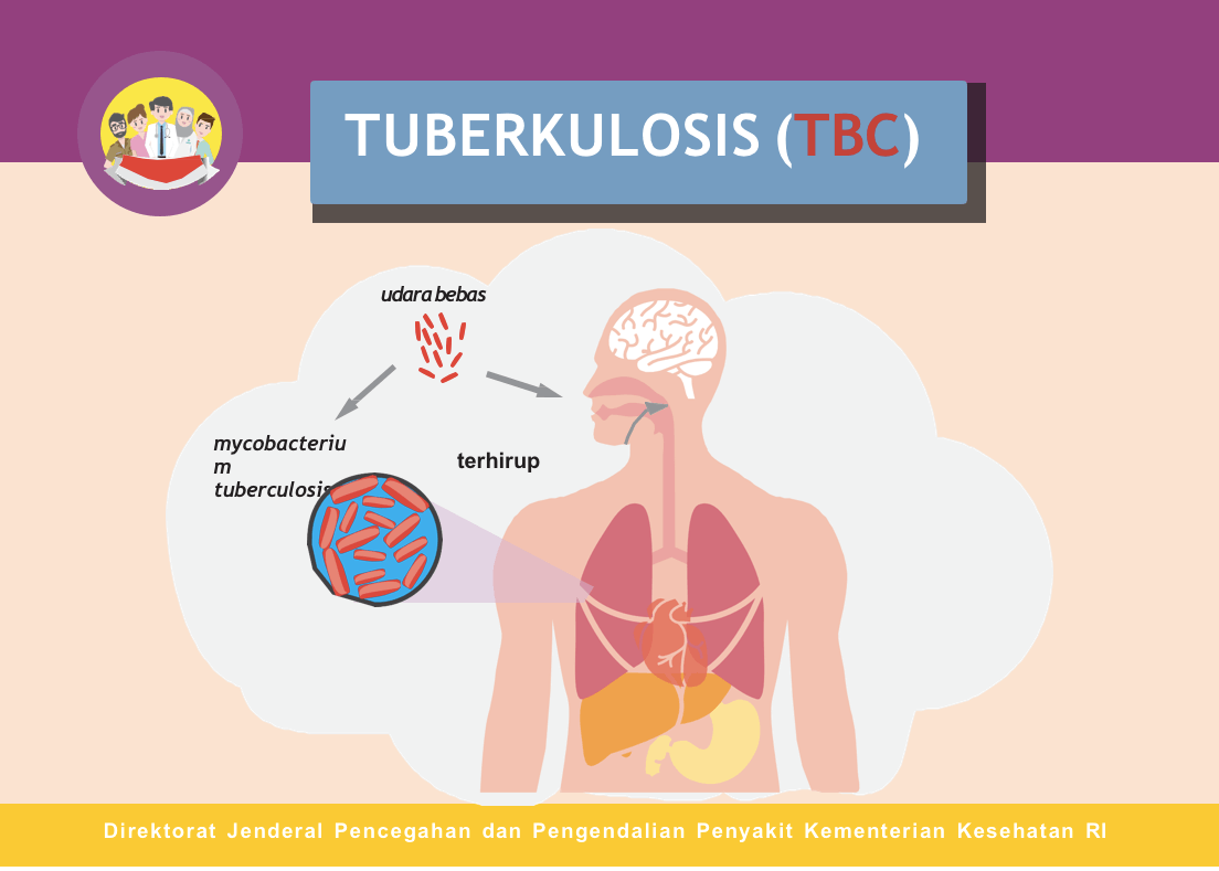 Informasi Dasar Seputar TBC - YABHYSA NGAWI